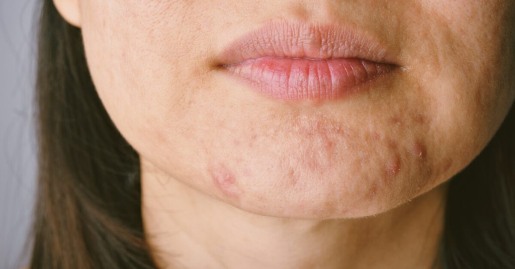 Could Lymphatic Drainage Help Clear Acne? ⋆ Sunnybrae Therapeutics